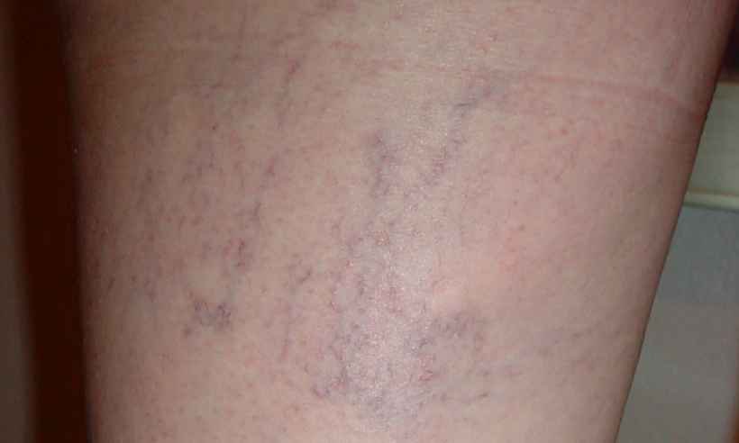 Varizes em Membros Inferiores : o que são? - Uai Saúde